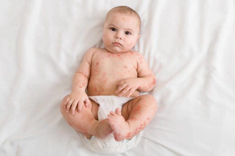 Male boginje (Morbili) - Sve što trebate da znate | Moja Praktika